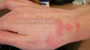 Spot the Signs: How to identify scabies